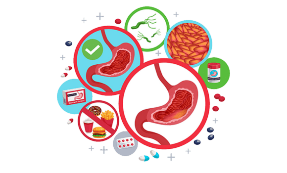 Gastritis – GIM